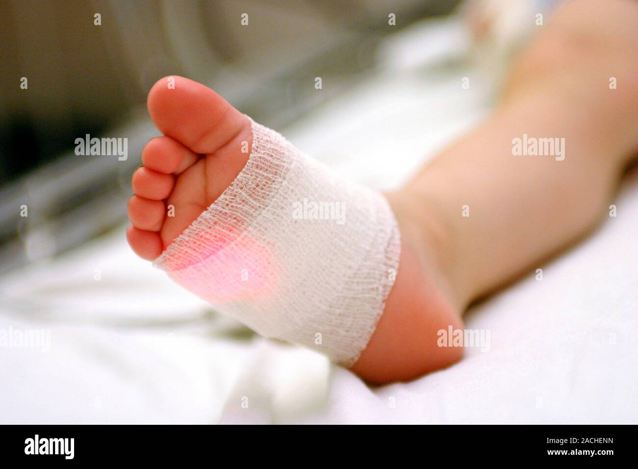 Paediatric hospital care. Close-up of the bandaged foot of a young girl ...