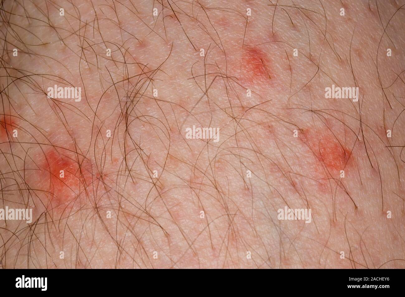 Close-up of mosquito bites on the skin of the leg of a 50 year old male ...