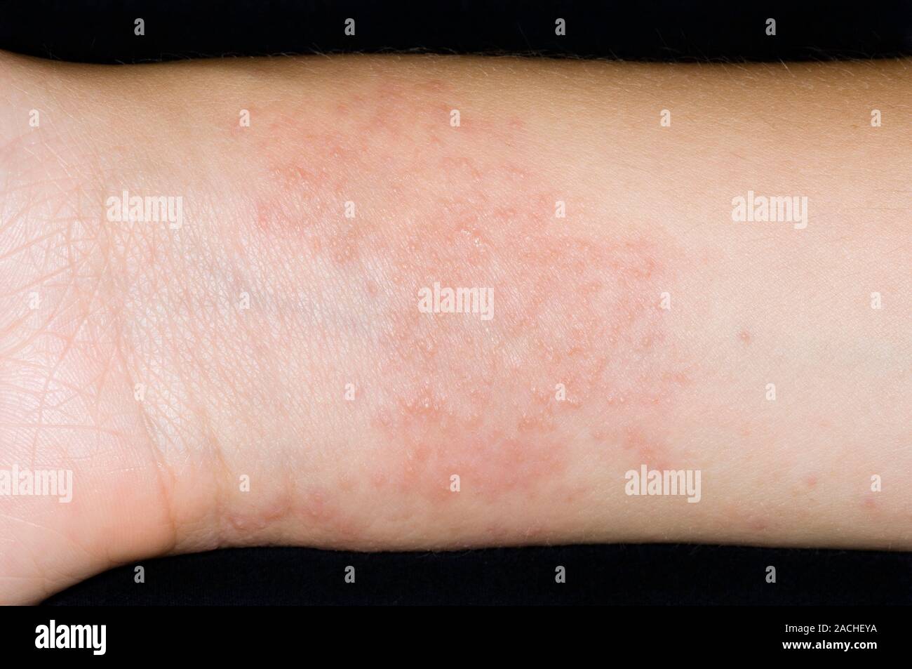 Close-up of the wrist in a 19 year old female patient with a rash due ...