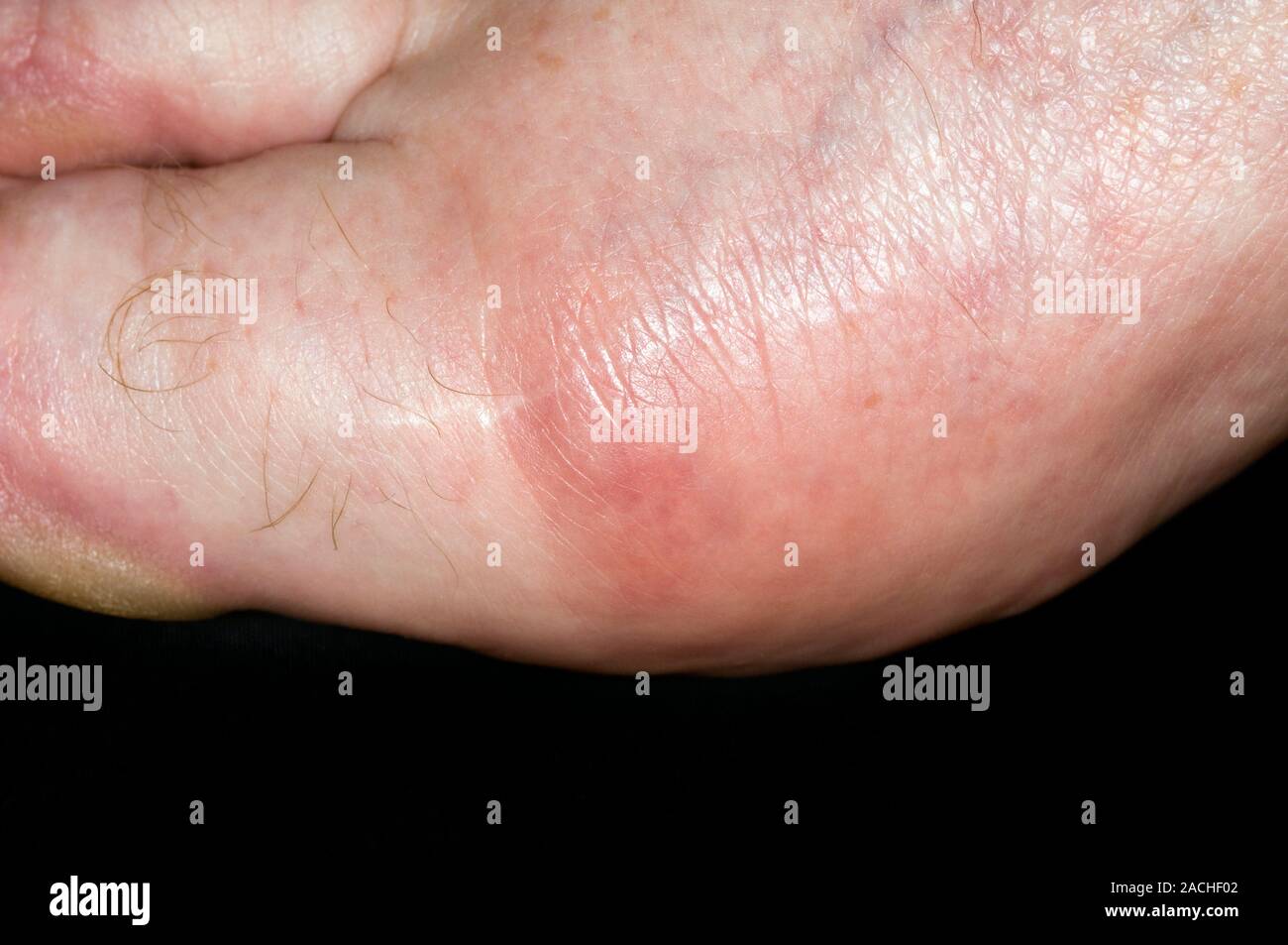 Uric Acid Crystals On Skin Gout | Causes, Symptoms, Treatments
