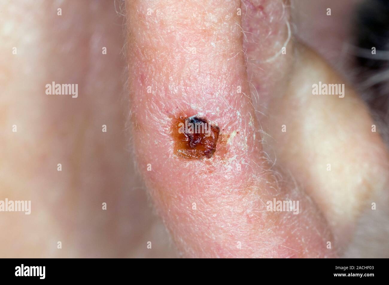 Close Up Of Basal Cell Carcinoma Bcc Or Rodent Ulcer On The Ear In
