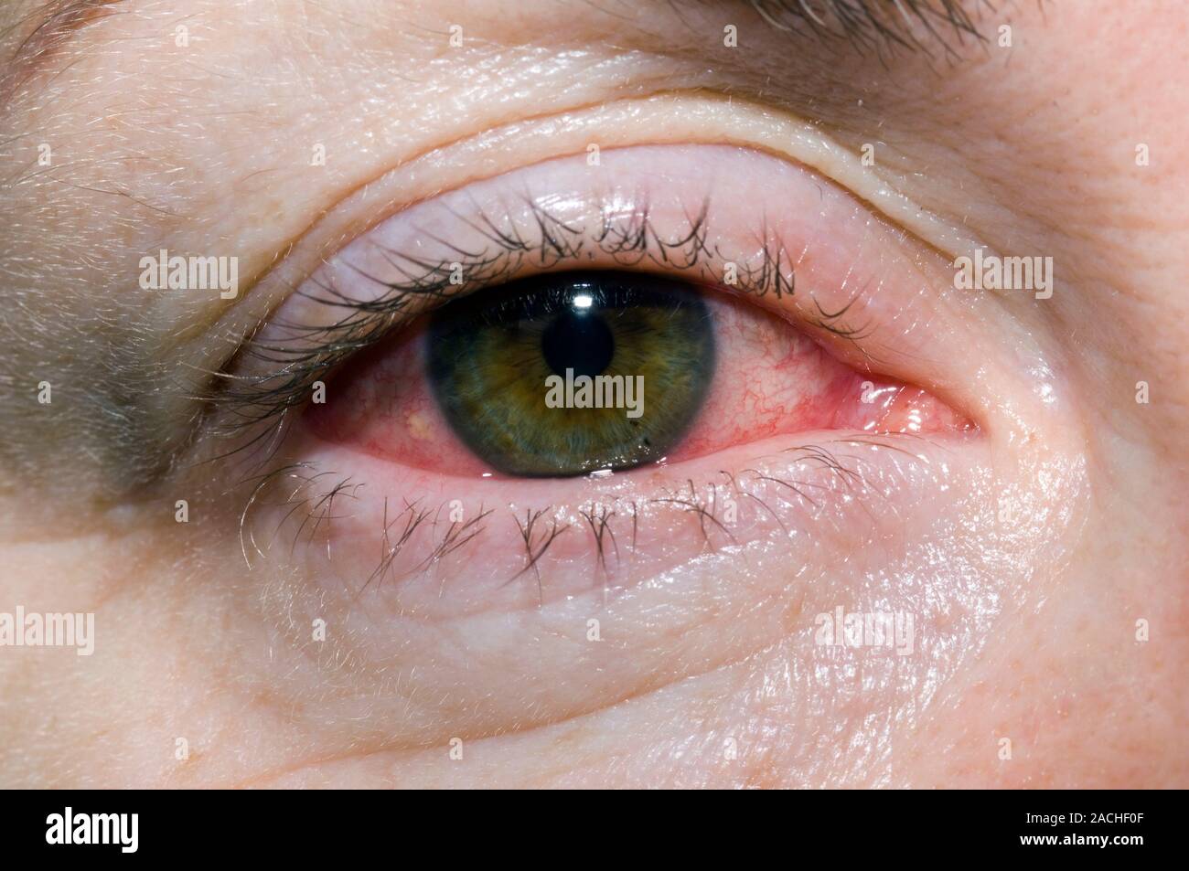 Close-up of the red eye in a 47 year old female patient with ...