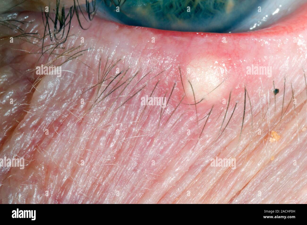 Close-up of the lower eyelid in a 76 year old male patient showing a ...