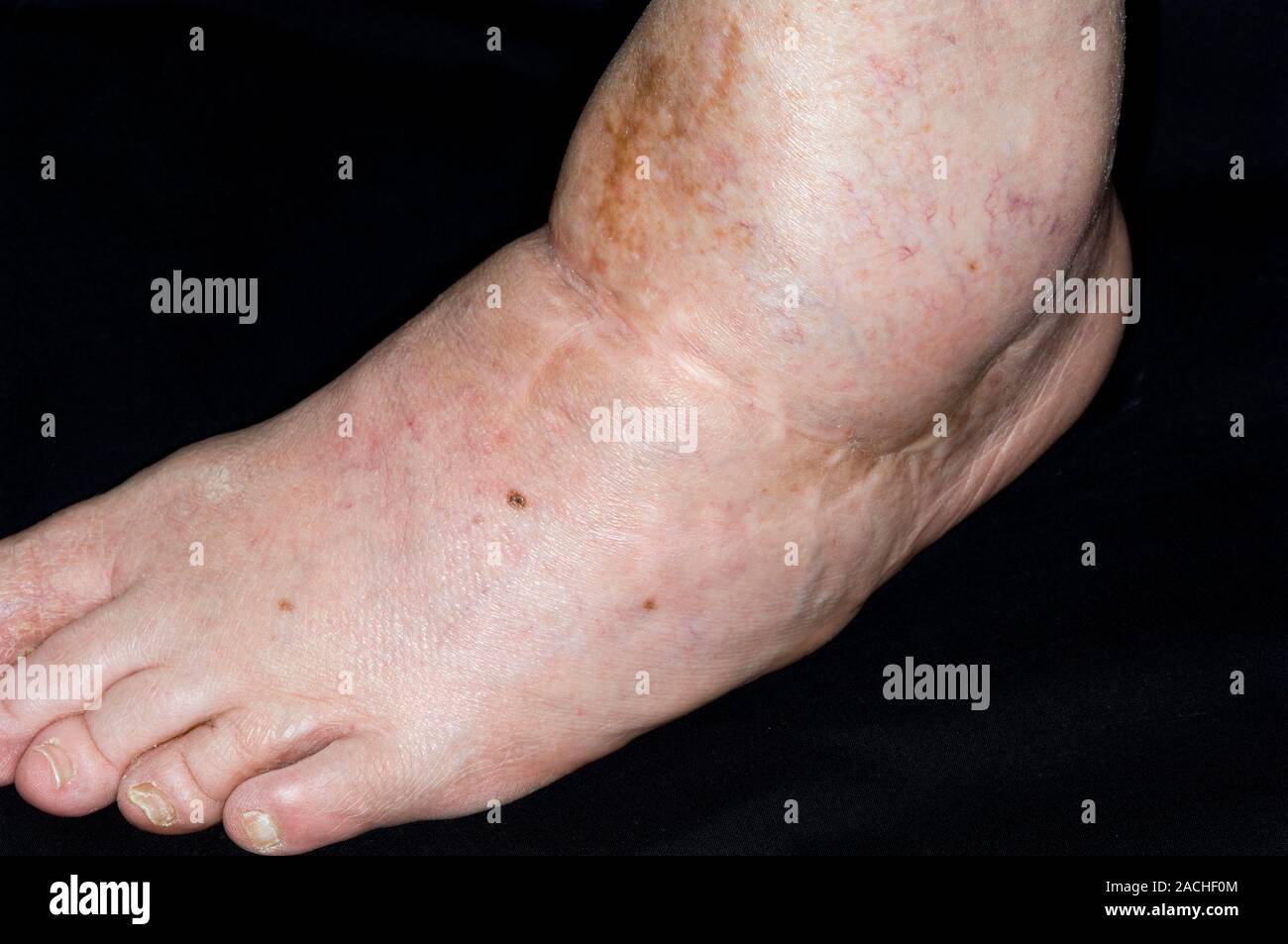 Swollen foot and ankle in a 73 year old male patient from previous ...