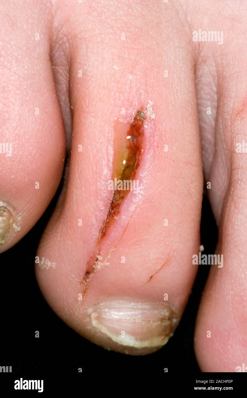 Laceration on the toe of a 19 year old male patient, from broken glass ...