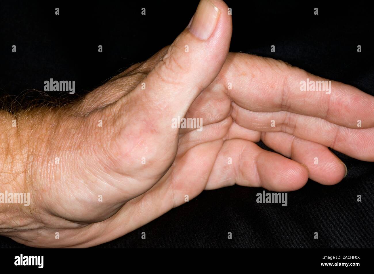 Thumb after surgery to treat dislocation of the thumb joint in a 53 ...