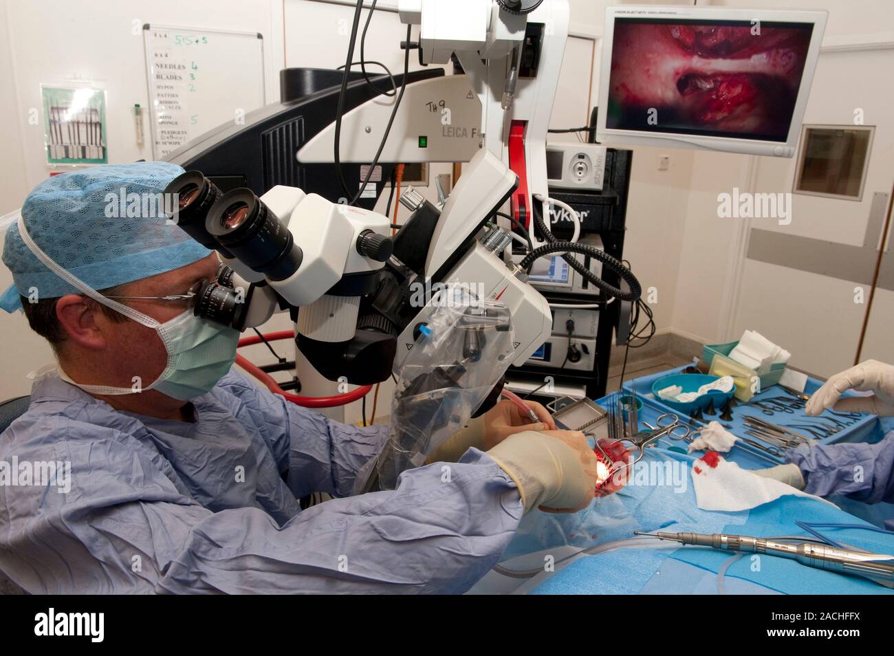Ear surgery. Surgeon using a binocular microscop during surgery on a 35 ...