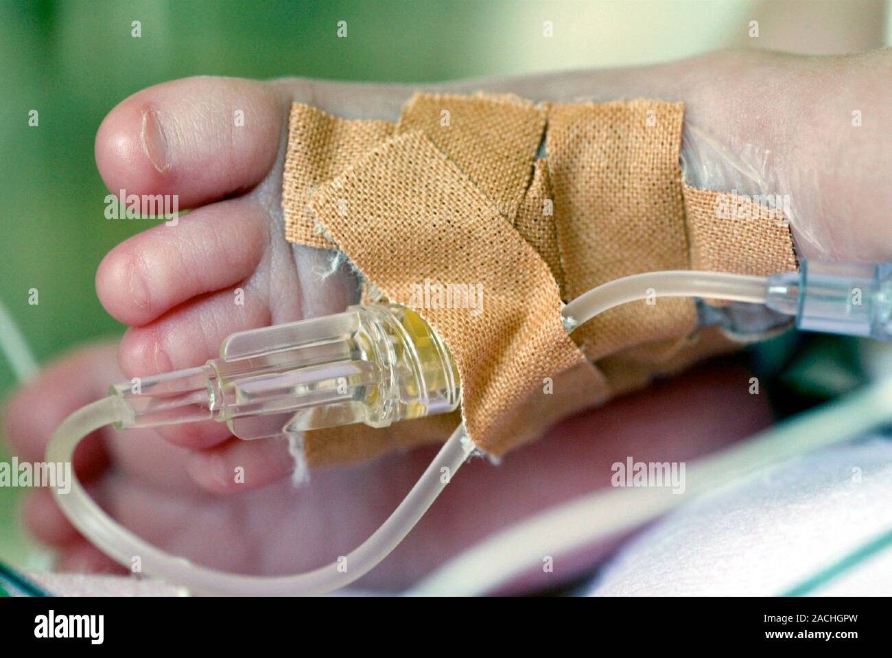 Premature baby. Close-up of a cannula in the foot of a newborn ...