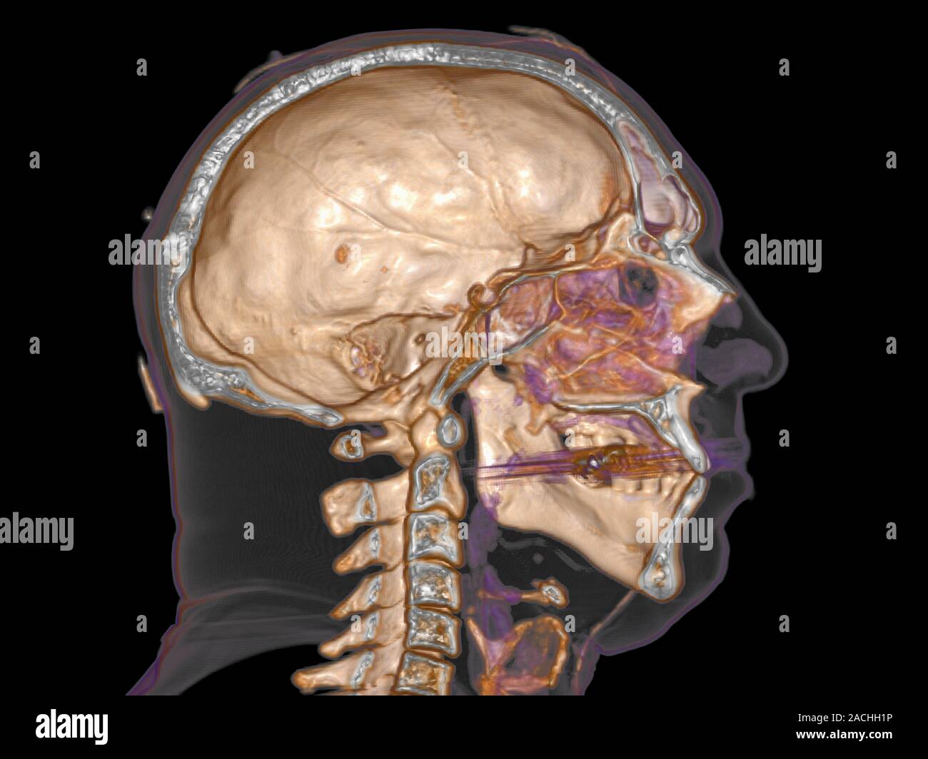 Normal head, 3D CT scan. Side view 3D model of a person's head using x ...