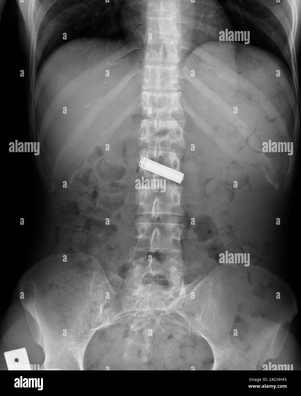 Swallowed battery. X-ray of the abdomen of a patient with dementia that ...