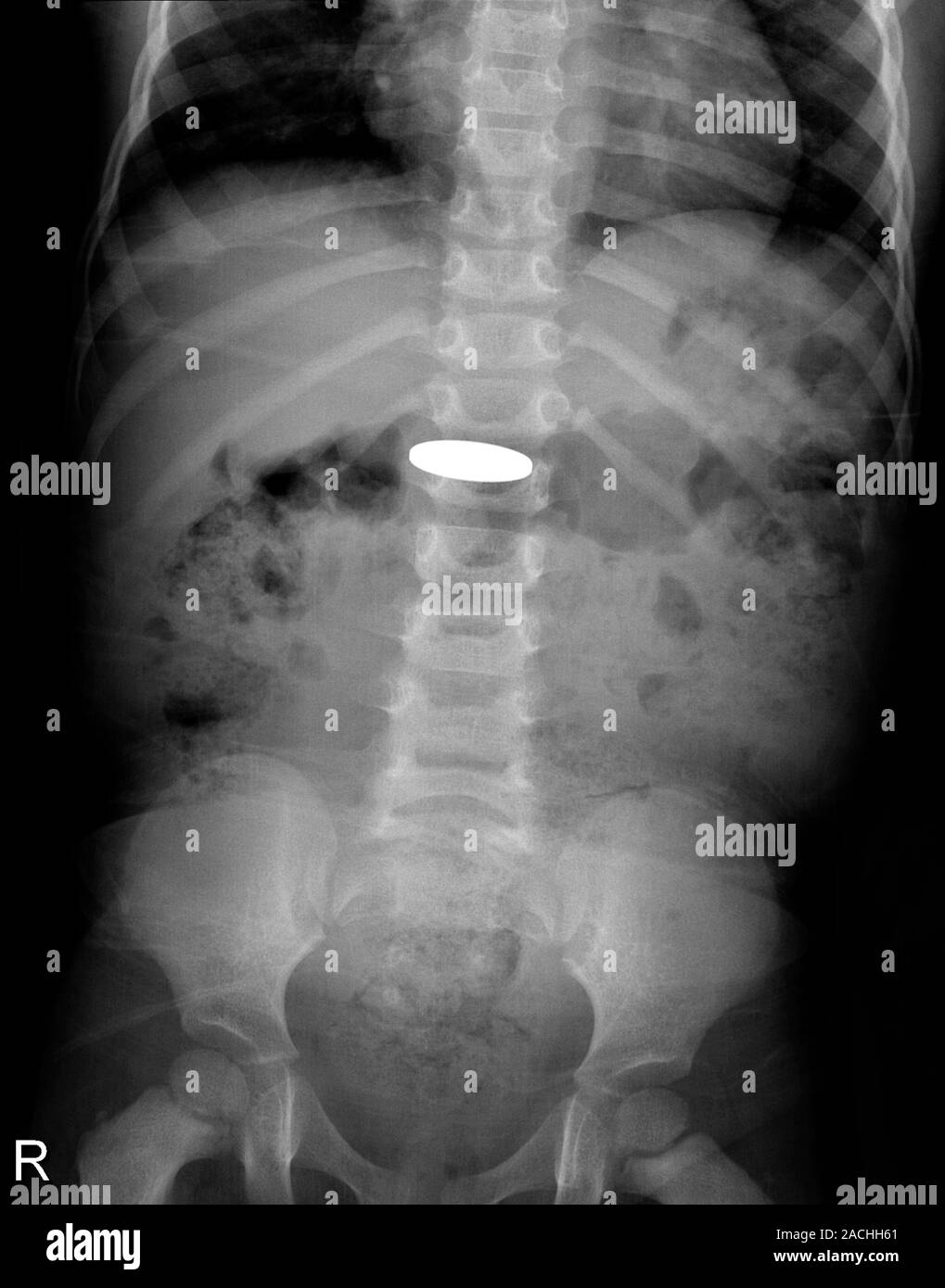 Swallowed coin, X-ray. Child who has swallowed a coin (centre middle ...