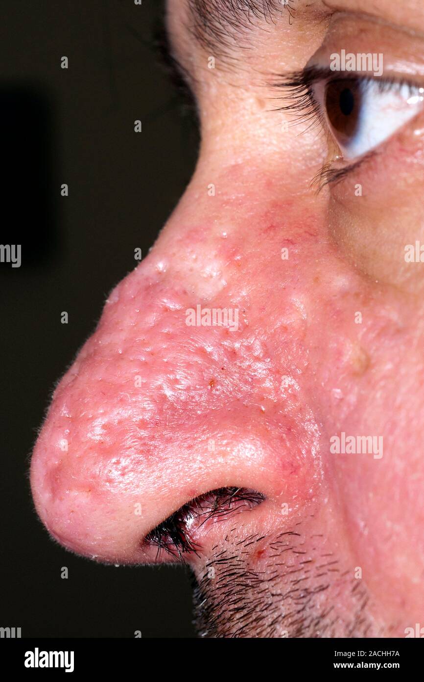 Rhinophyma of the nose. Side view of the bulbous red nose of a 38-year ...
