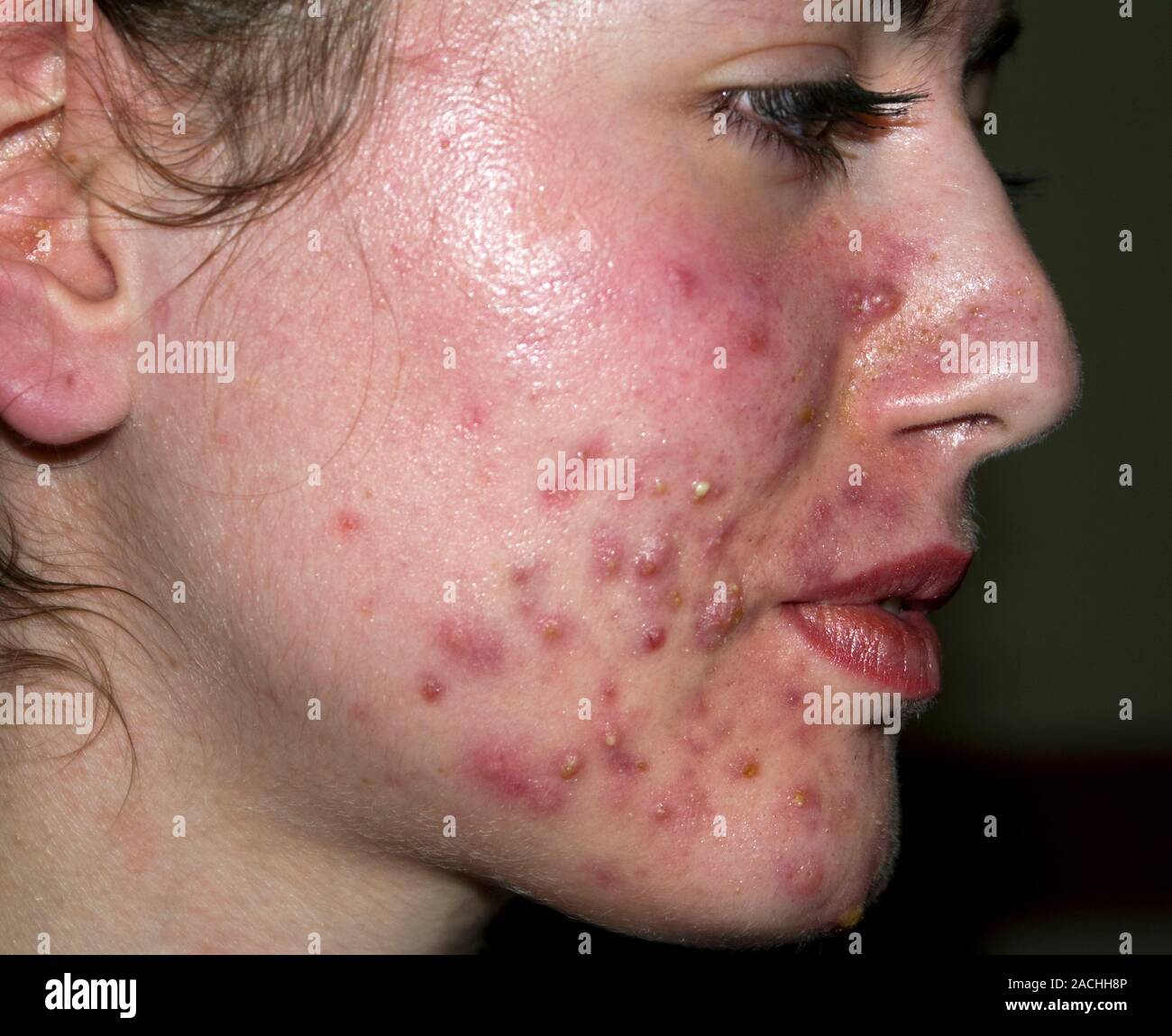 Acne. Pustular acne and excessively oily skin on a teenage girl's face ...