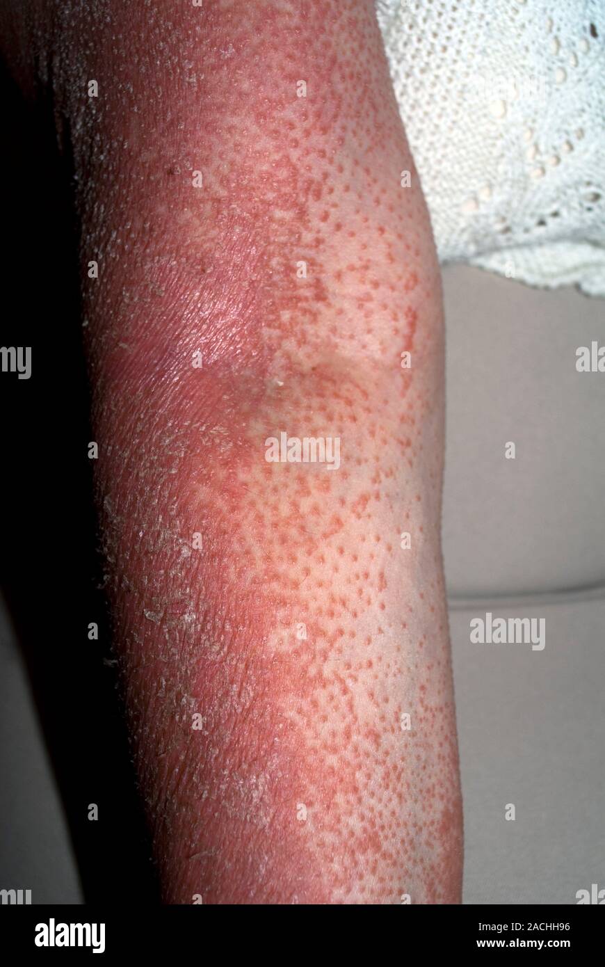 Pityriasis rubra pilaris. Small follicular papules topped with horny ...