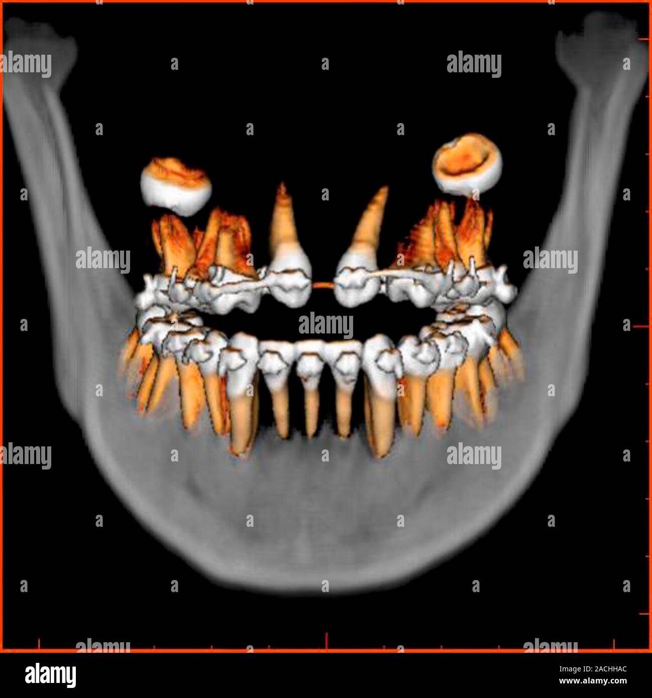 Teeth, 3D CT scan. Frontal view of a person's jaw and teeth with braces ...