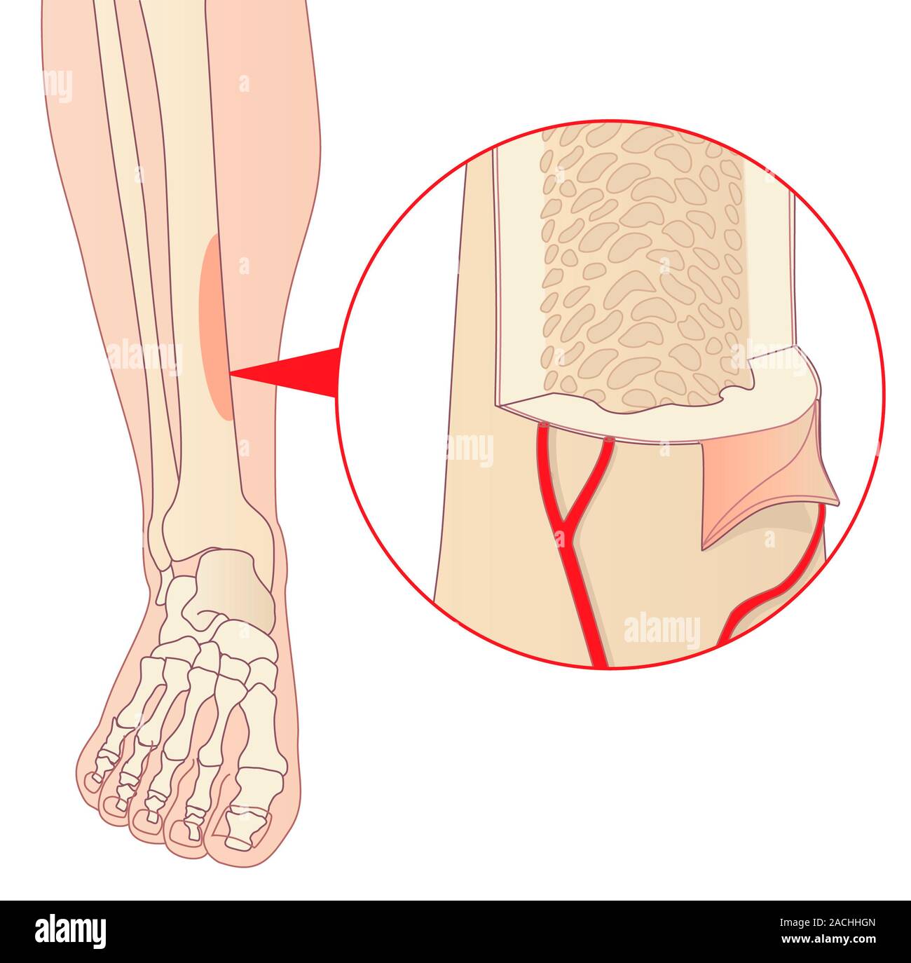 Shin splints. Computer artwork of a lower leg showing an area of the ...