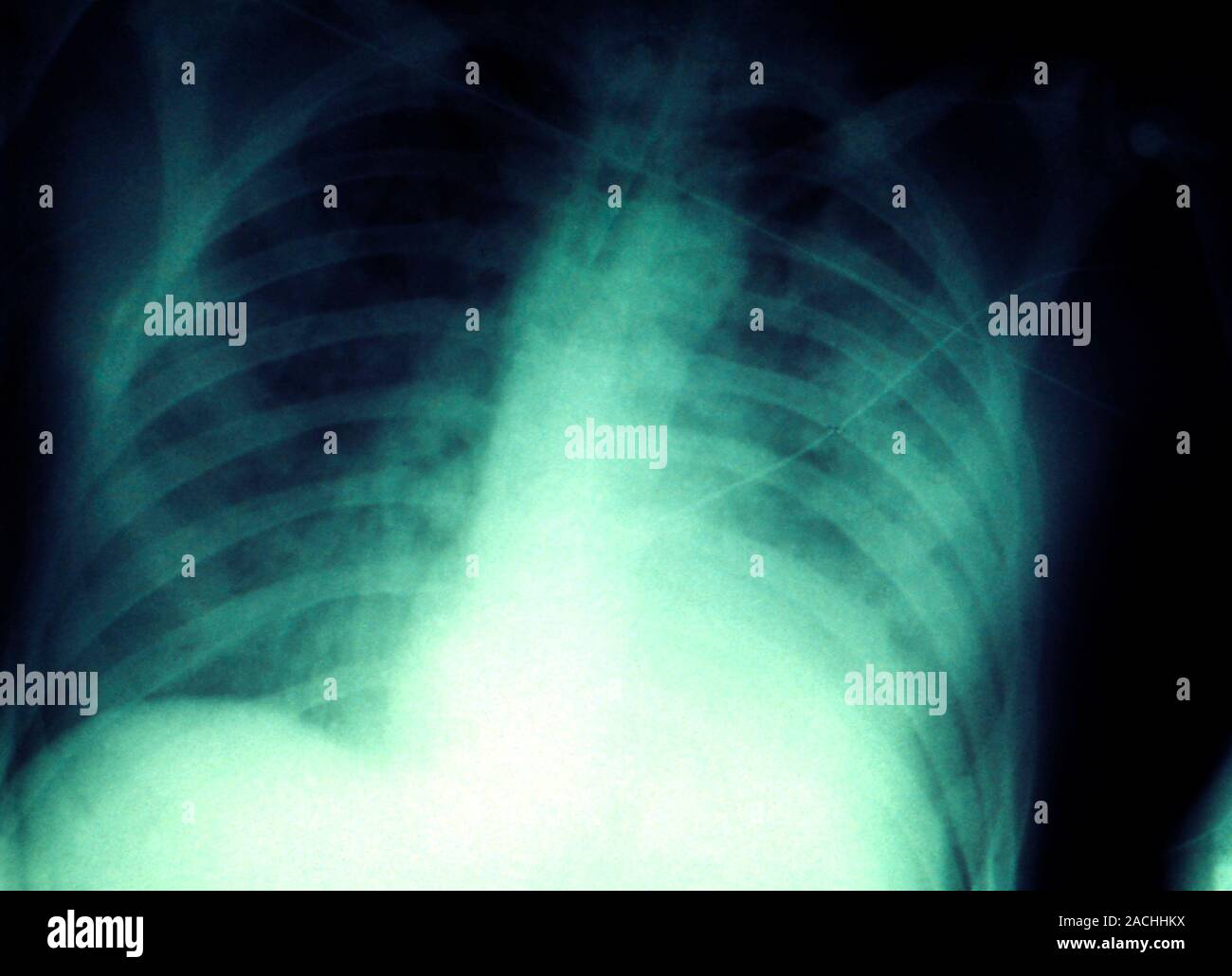 Bacteria Da Peste Pneumonica Plague The Lancet