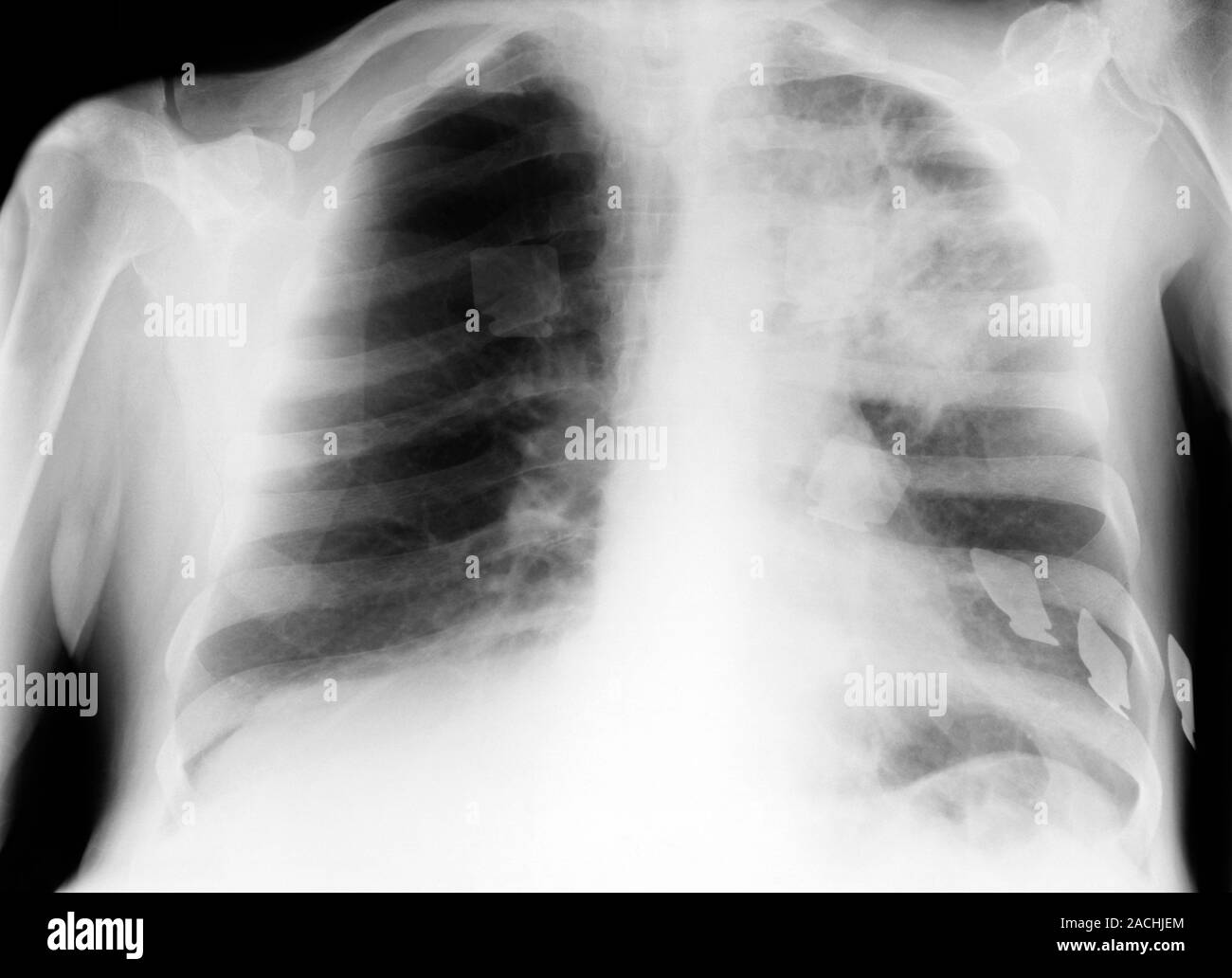 X-ray (front view) of the chest in a 73 year old male patient, showing ...