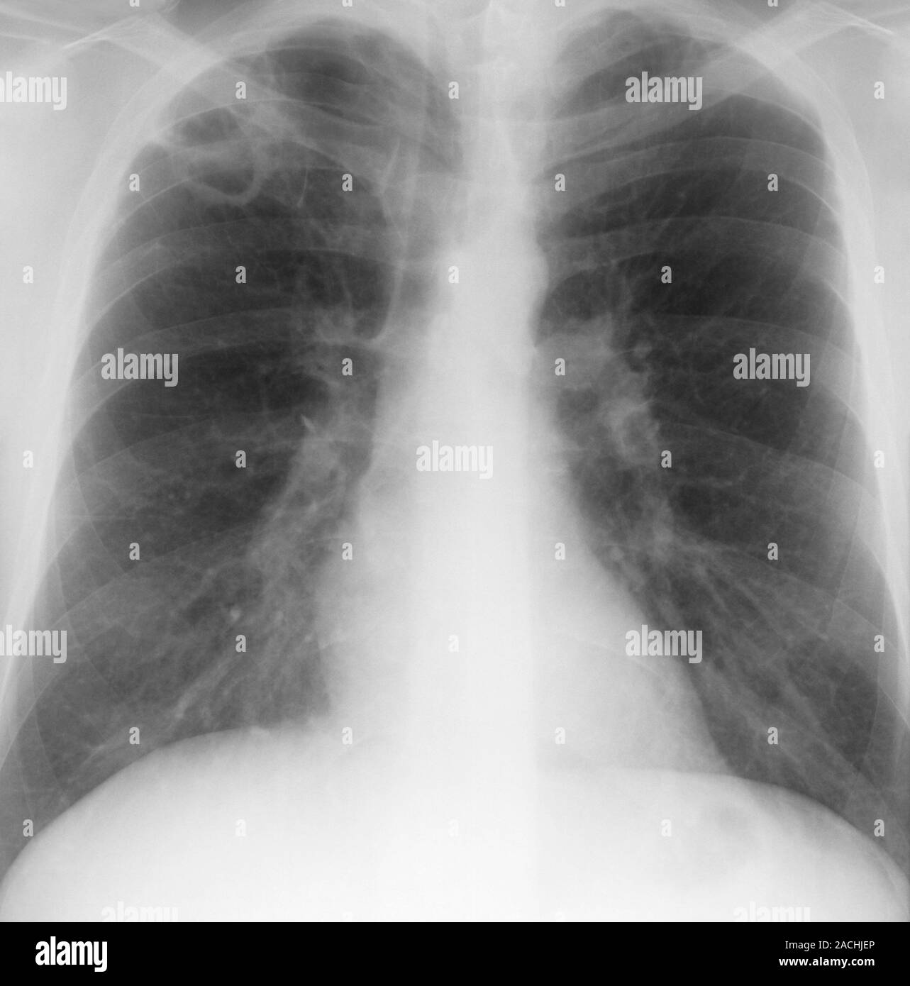 X-ray (front view) of the chest in a 29 year old male patient, showing ...