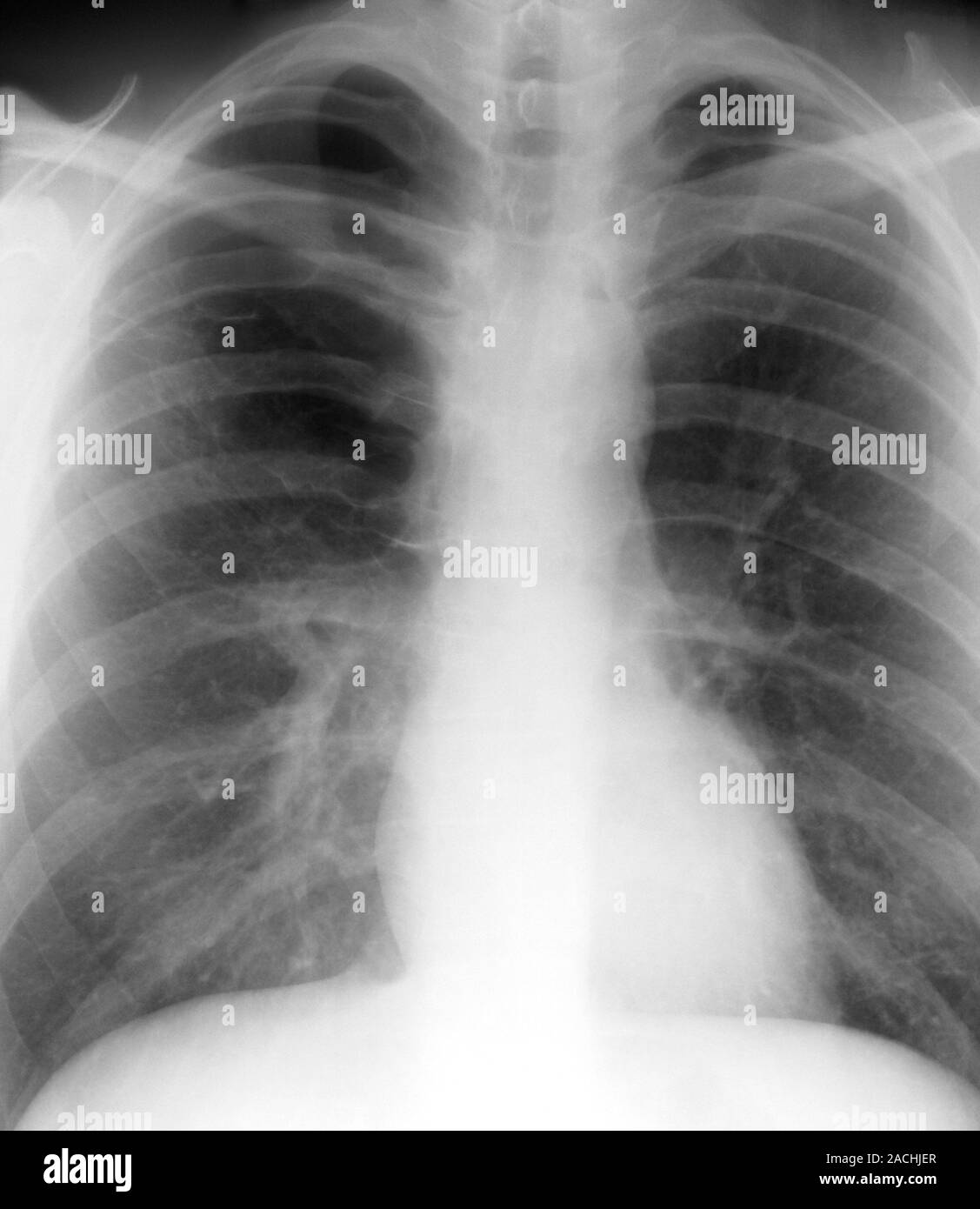 X-ray (front view) of the chest in a 41 year old male patient, showing ...