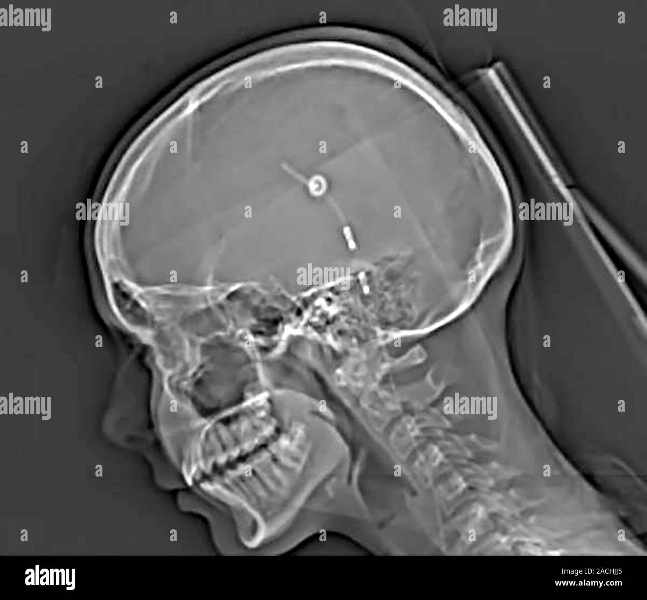 Cerebral shunt. X-ray image showing the placement of a ventriculo ...