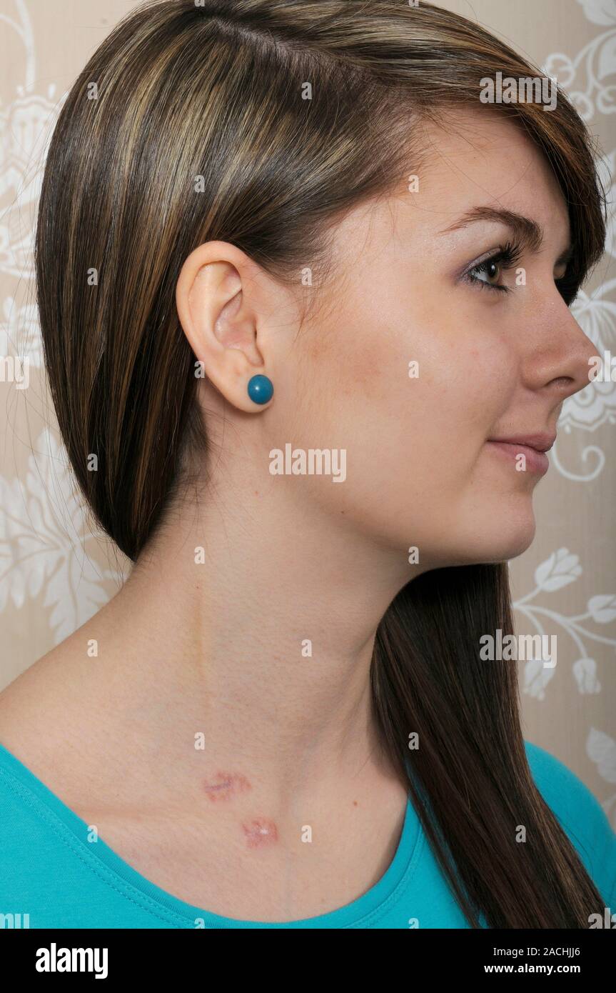Cerebral shunt. Image showing an internal ventriculo-atrial shunt under ...