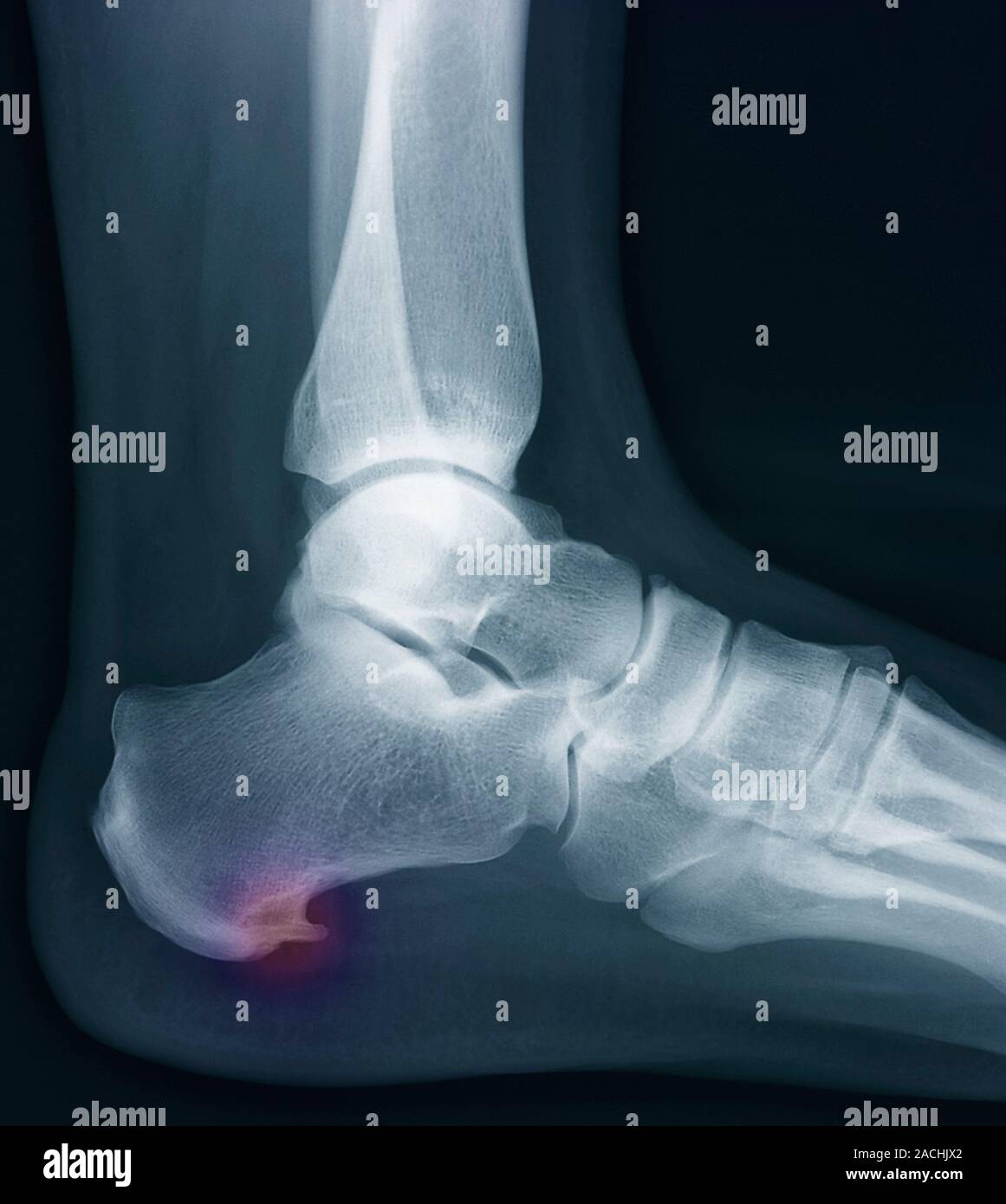 Heel bone spur. Coloured lateral X-ray of the ankle and upper part of ...