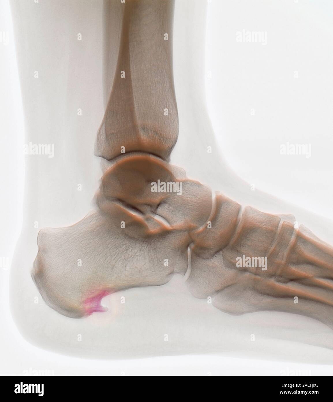 Heel bone spur. Coloured lateral X-ray of the ankle and upper part of ...