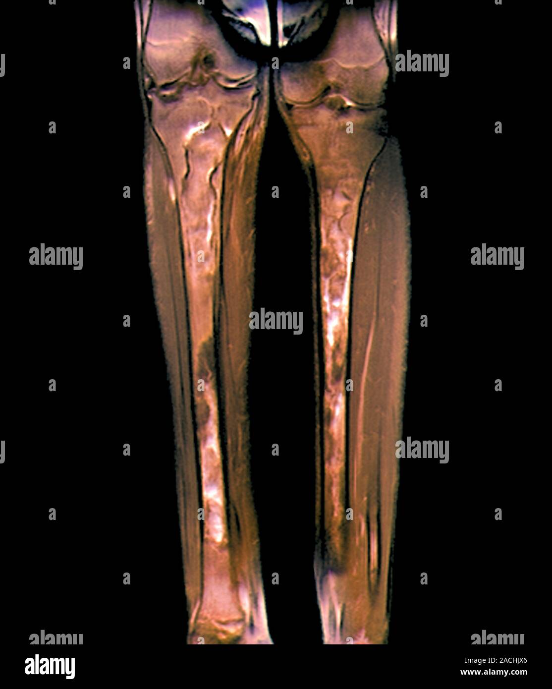 Osteomyelitis in lower legs. Coloured coronal magnetic resonance ...