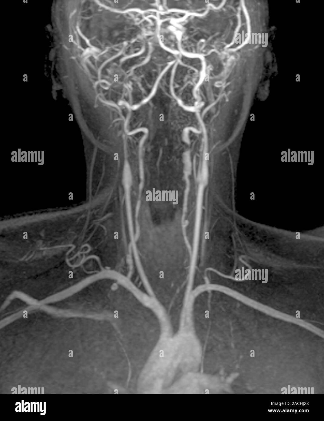 Neck and brain aneurysms. Coronal magnetic resonance angiography (MRA ...