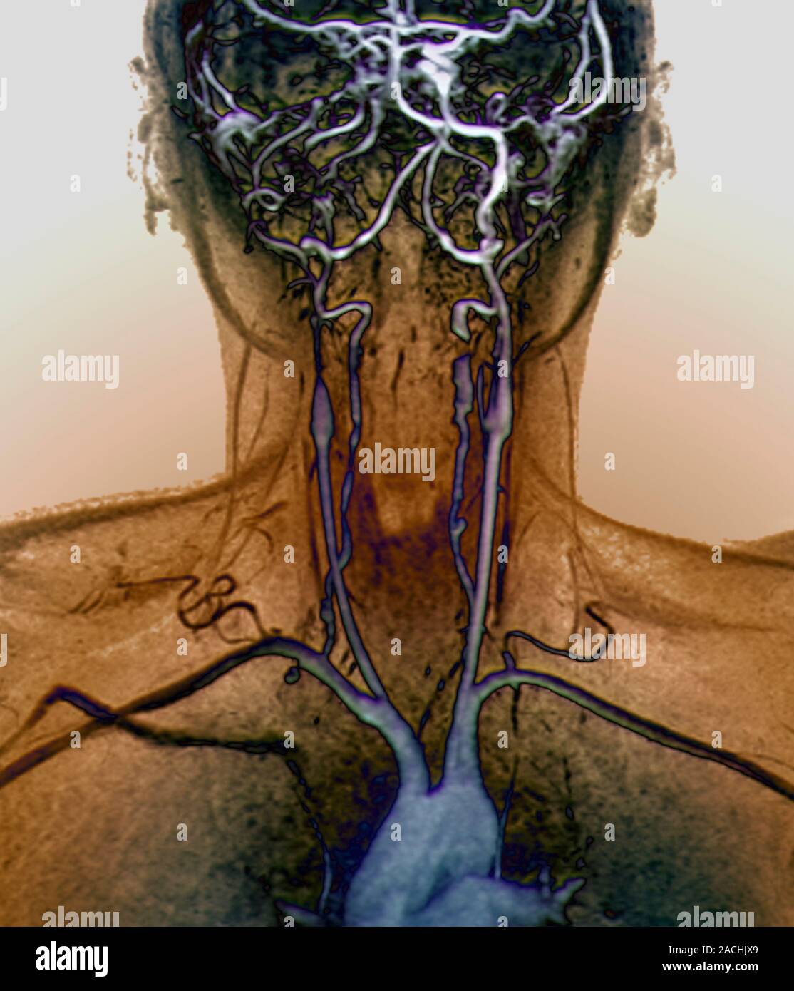 Neck and brain aneurysms. Coloured coronal magnetic resonance ...