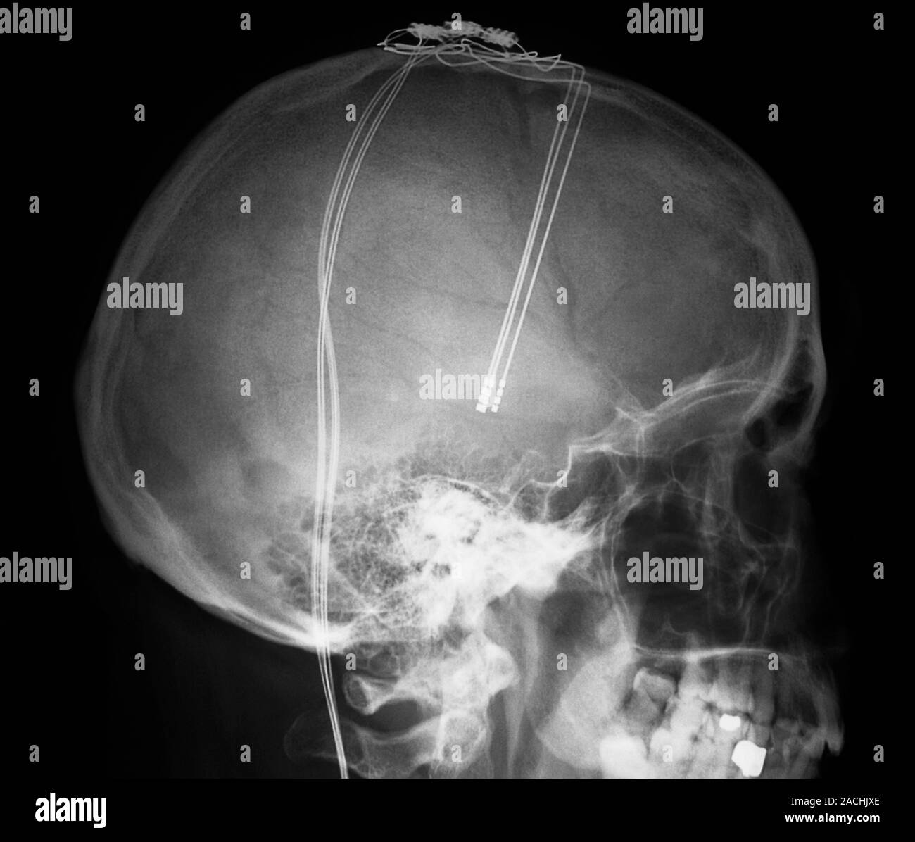 Deep brain stimulation (DBS) electrodes. Lateral X-ray of electrodes ...