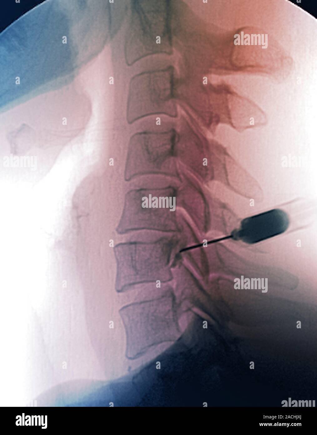 Neck pain treatment. Coloured lateral X-ray of the cervical (neck ...
