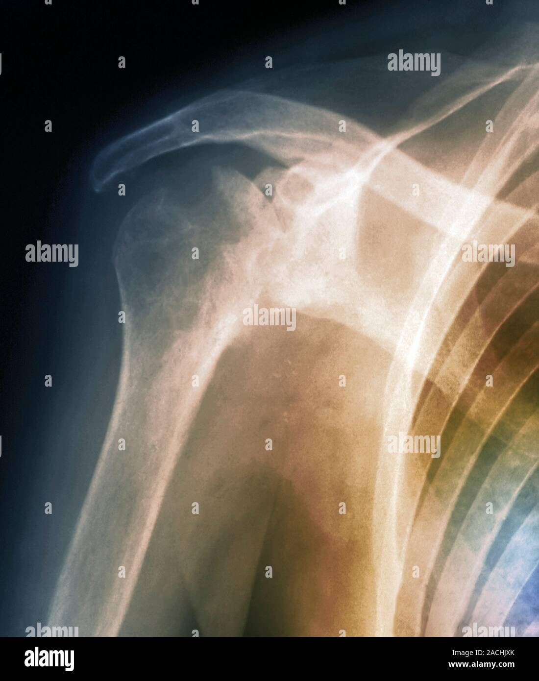 Arthritic shoulder. Coloured frontal X-ray image of the right shoulder ...