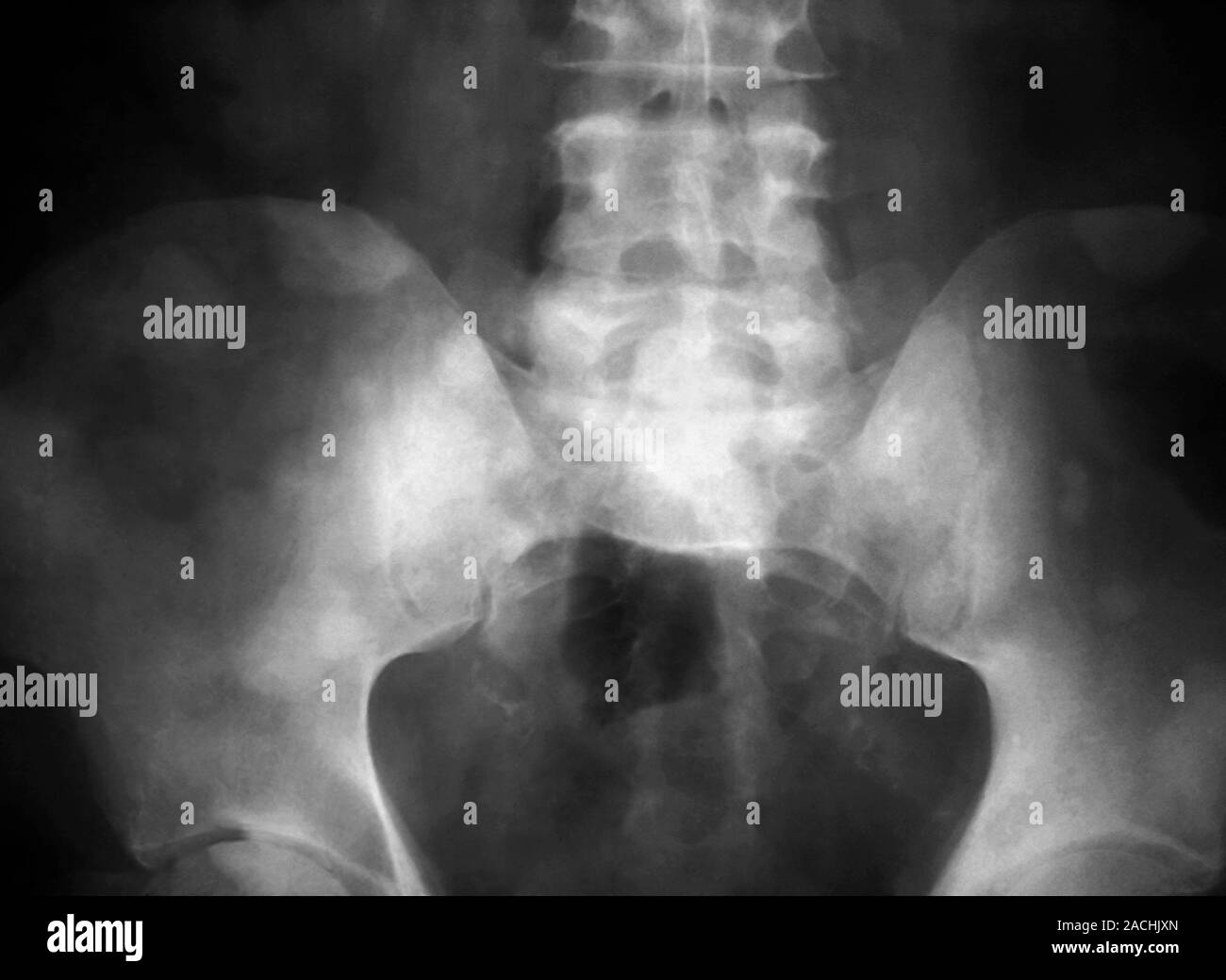 Secondary cancer in the pelvis. Frontal X-ray of the pelvis of a 65 ...