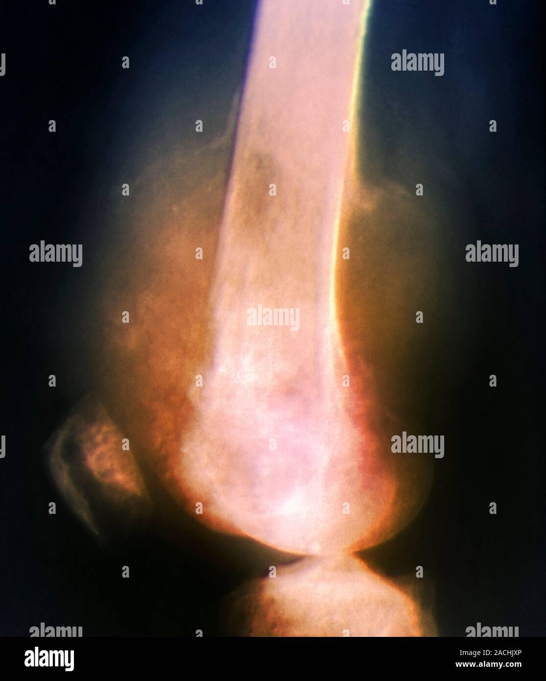 Bone cancer in the femur. Coloured lateral X-ray of a cancerous growth ...