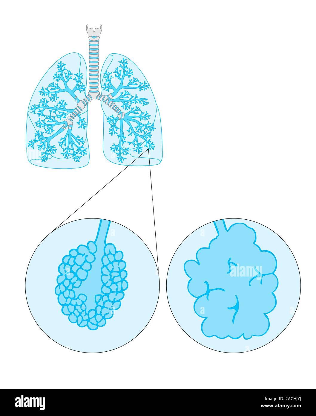 Emphysema. Artwork showing the lungs with a detailed view of a normal ...
