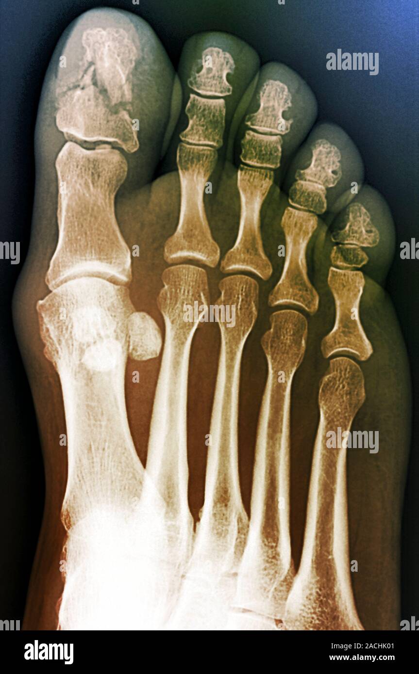 Broken toe bone. Coloured frontal X-ray of the right foot of a 52-year ...