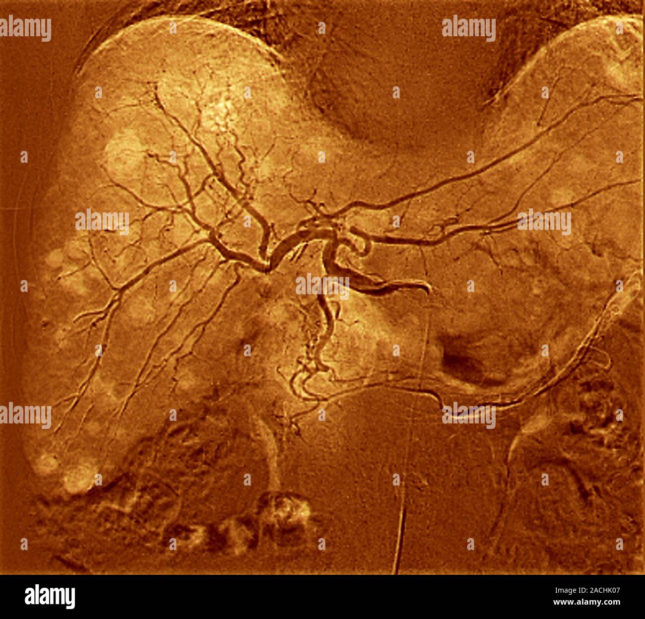 Secondary cancer in the liver. Coloured 3D angiogram (blood vessel X ...