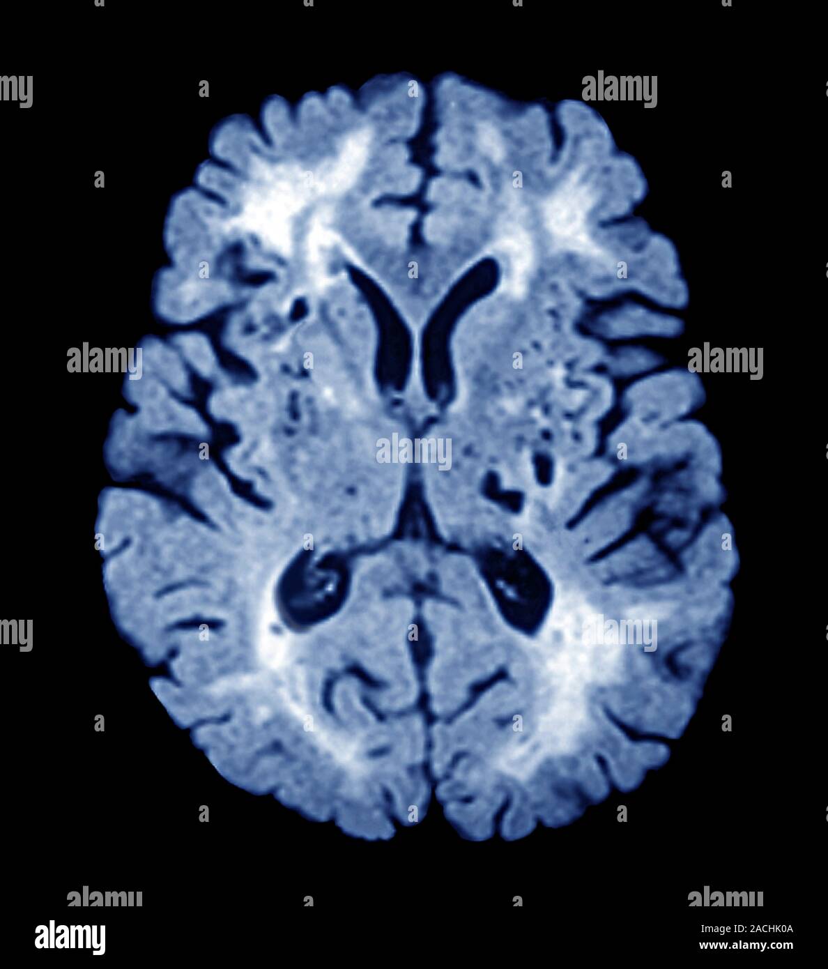 CADASIL syndrome. Coloured axial magnetic resonance imaging (MRI) scan ...