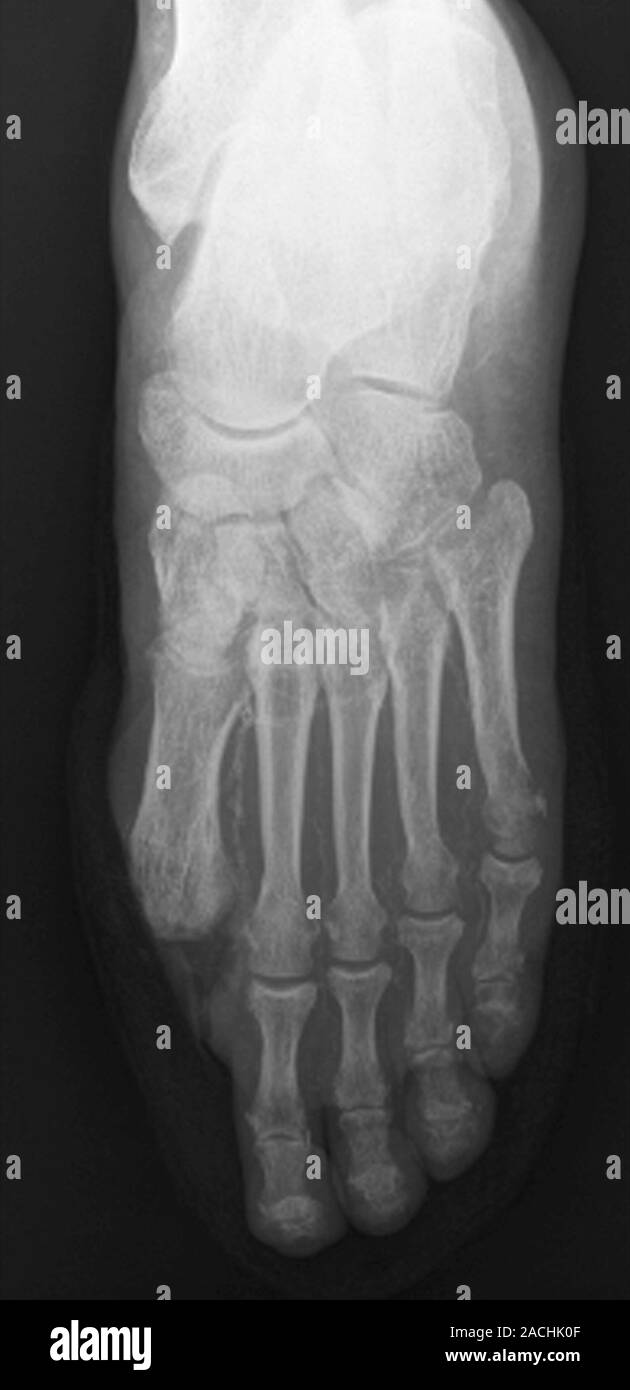 Toe amputation in diabetes. Frontal X-ray of the left foot of a 69-year ...