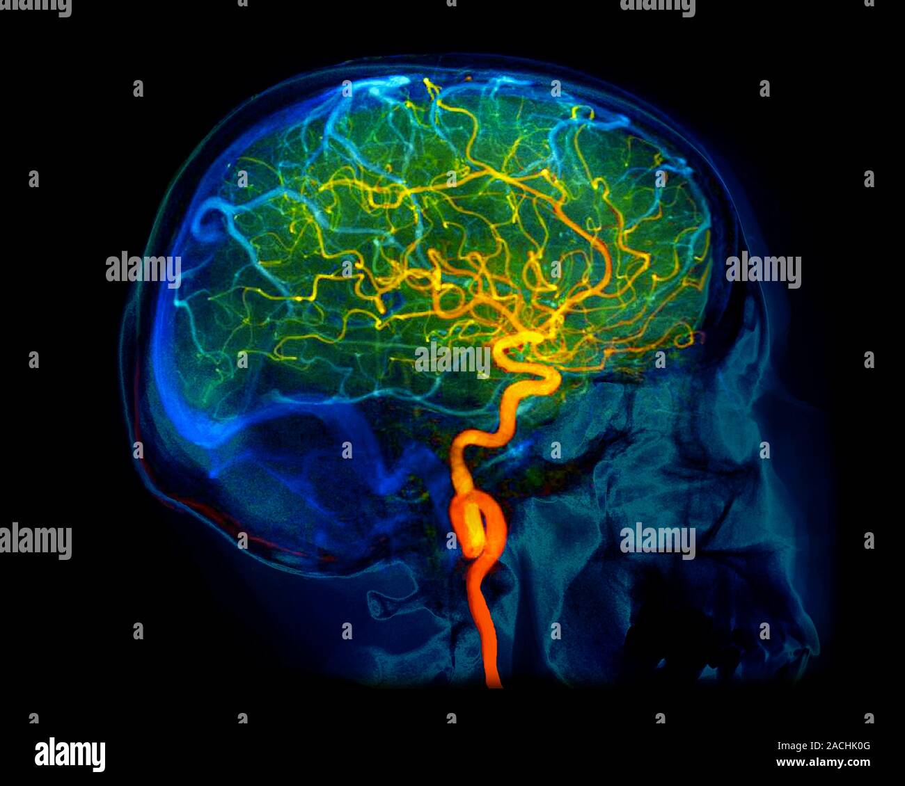 Brain blood vessels. Coloured 3D lateral angiogram (blood vessel X-ray ...