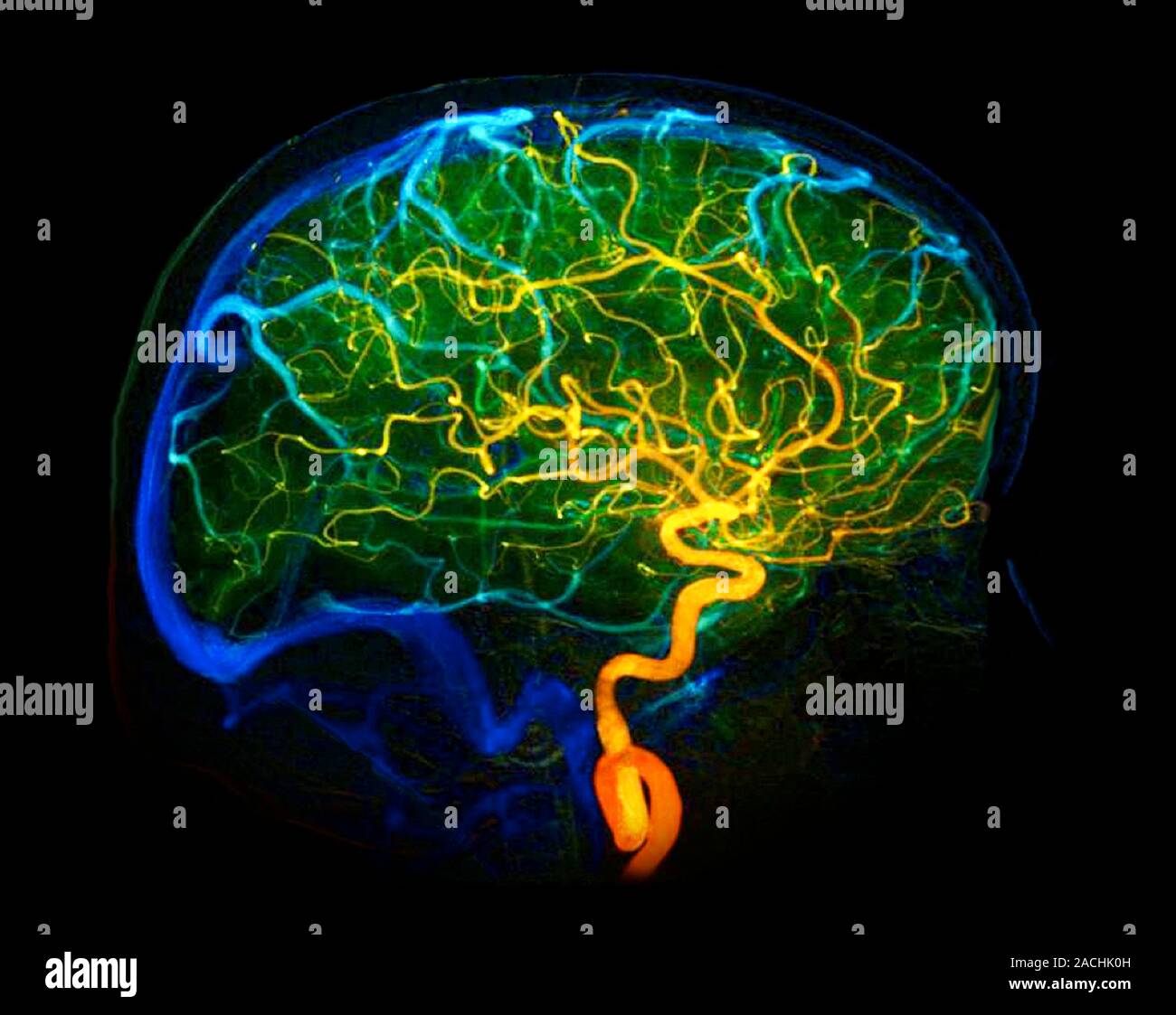 Brain blood vessels. Coloured 3D lateral angiogram (blood vessel X-ray ...