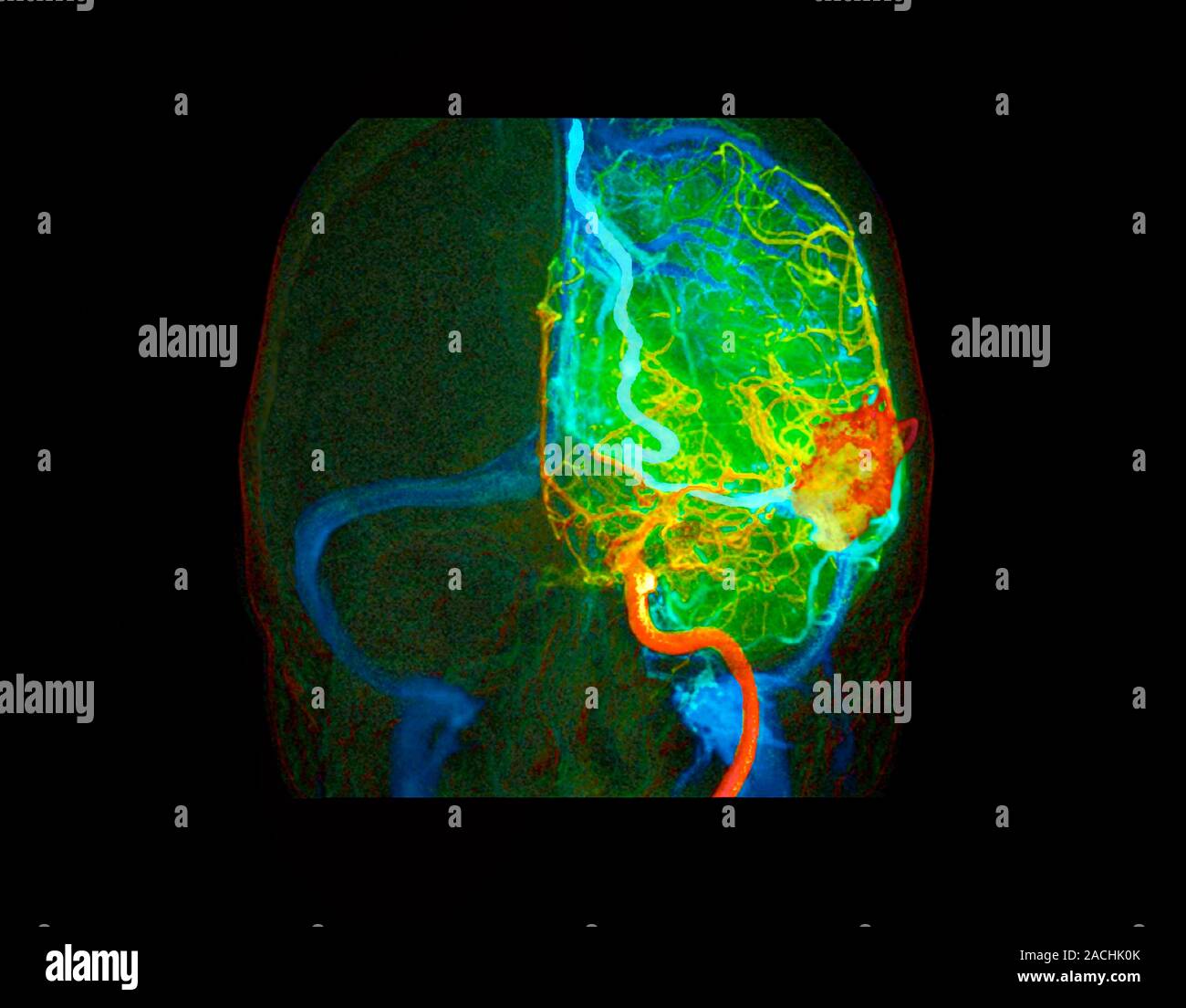 Arteriovenous malformation. Coloured 3D frontal angiogram (blood vessel ...