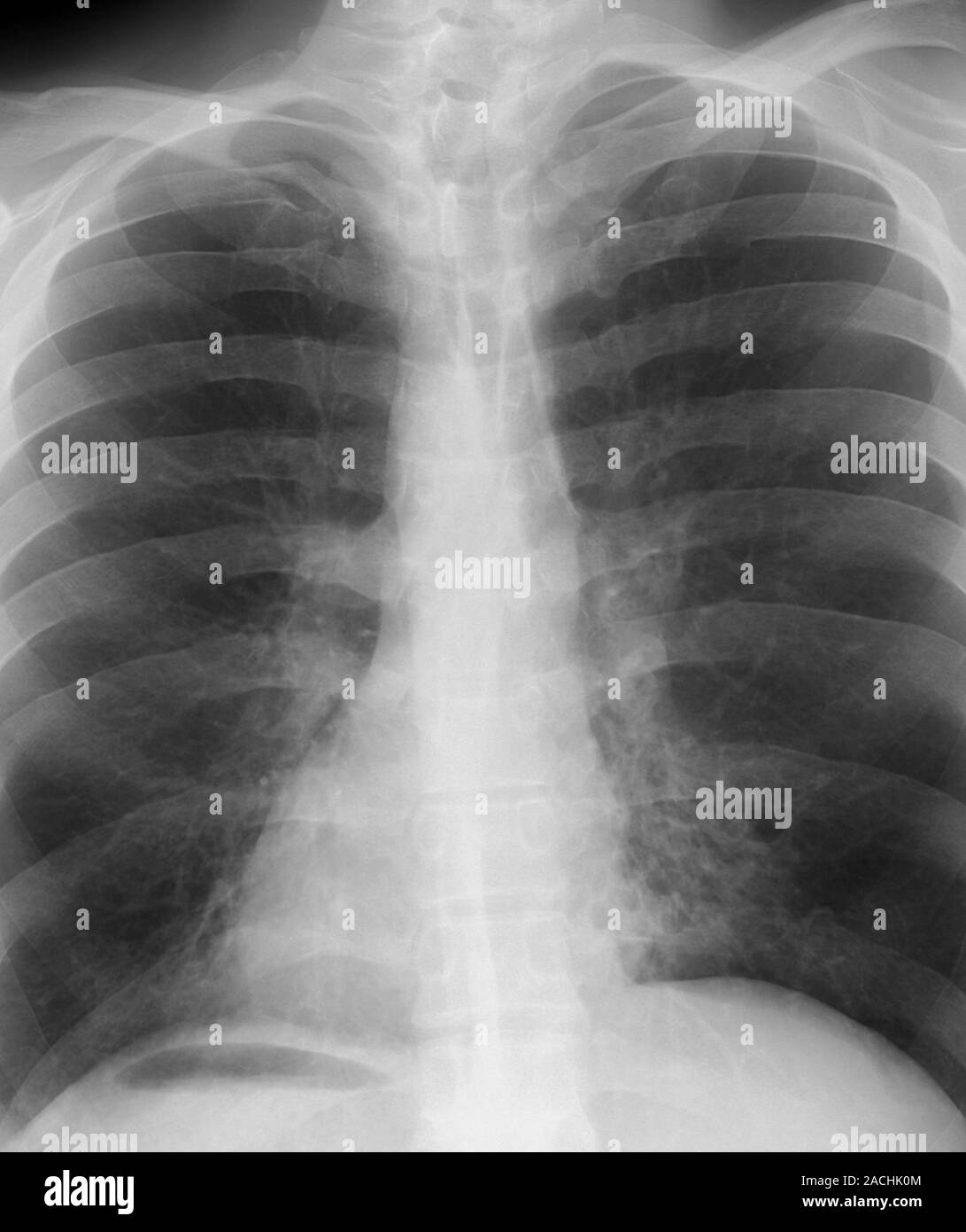 Kartagener Syndrome. Frontal X-ray of the lungs of a 28-year-old ...