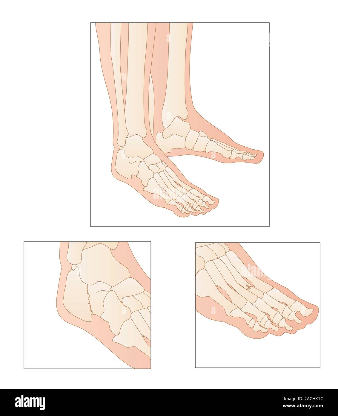 Foot fractures. Artwork showing a healthy foot (top), a foot with a ...