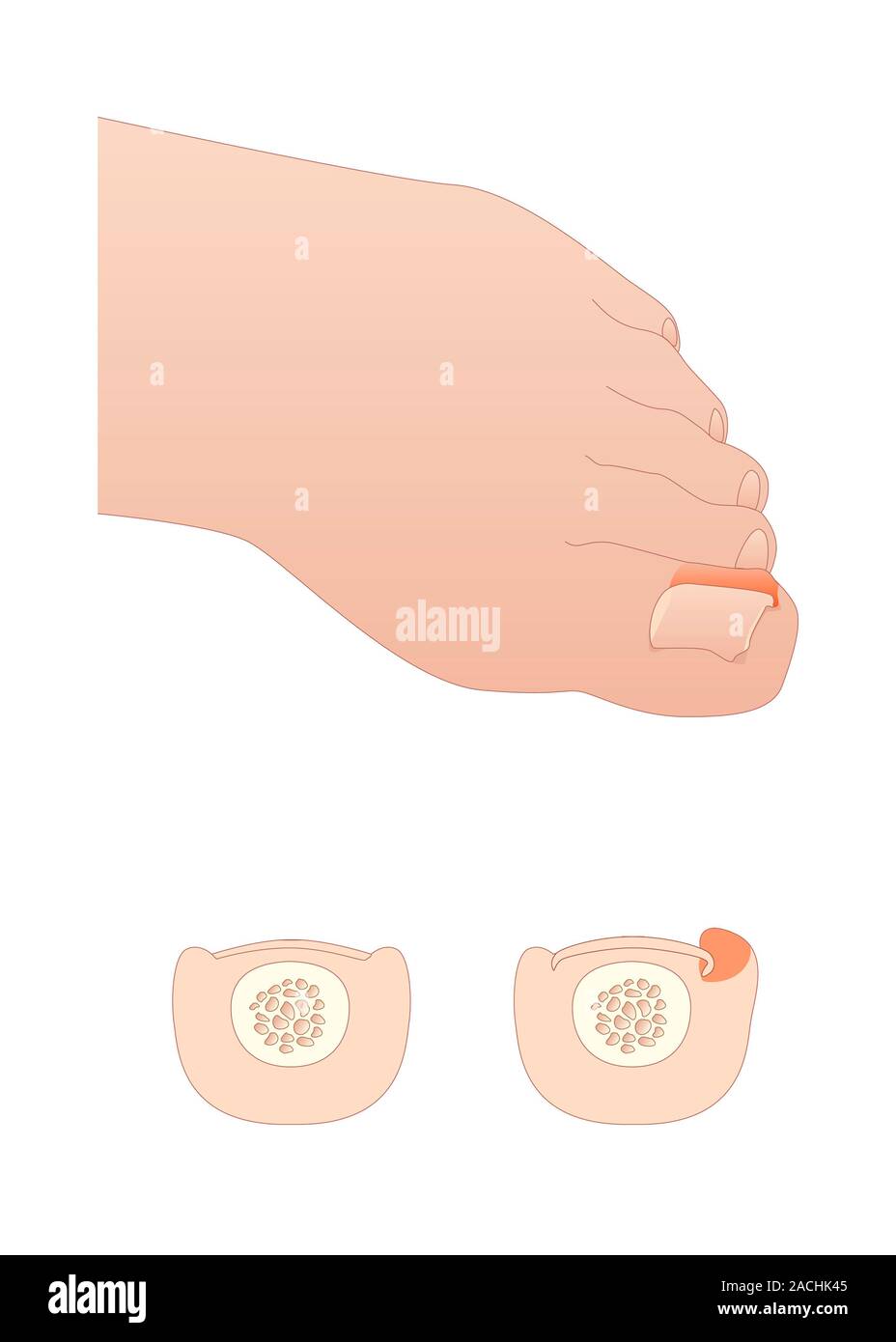 Ingrowing toenail. Artwork showing a normal toenail (bottom left) and ...