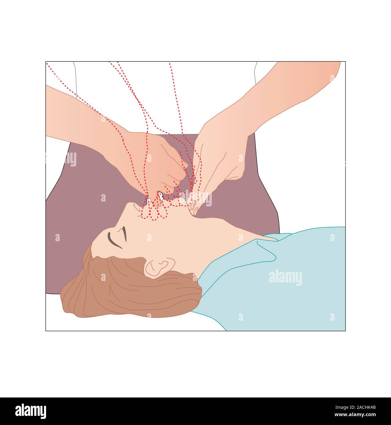 Artificial respiration. Artwork showing one of the first stages of artificial respiration, or ...