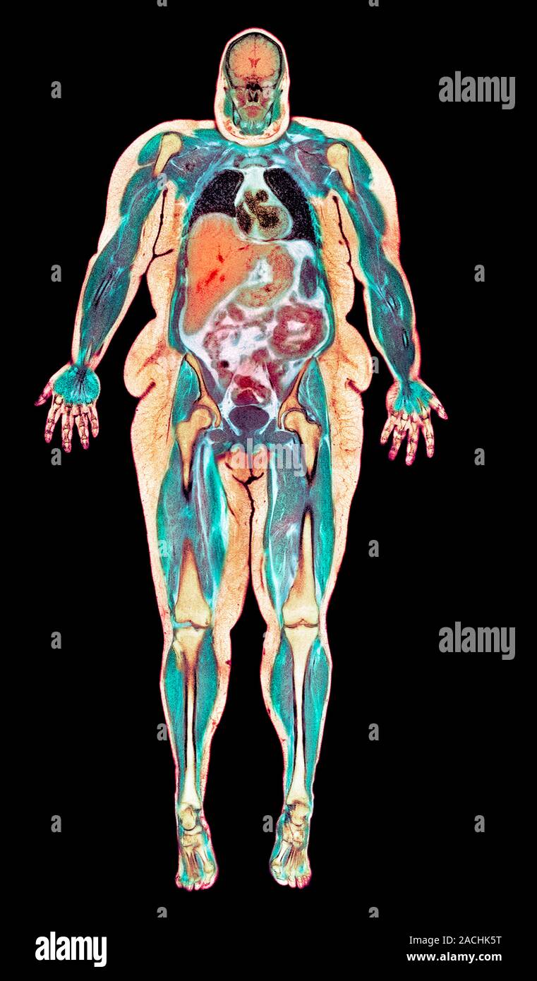 Obese woman, coloured magnetic resonance (MRI) scan. This coronal scan ...