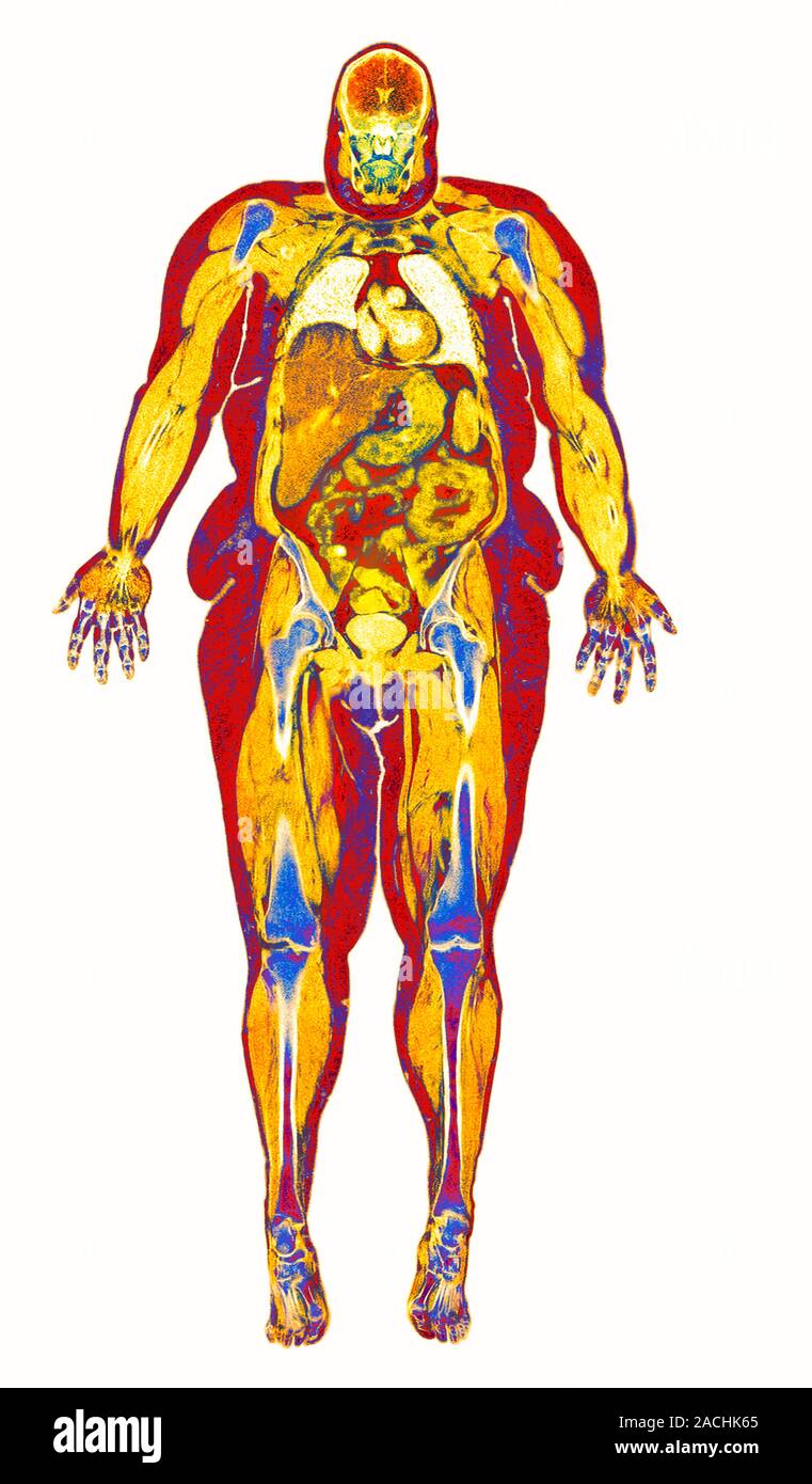 Obese woman, coloured magnetic resonance (MRI) scan. This coronal scan ...